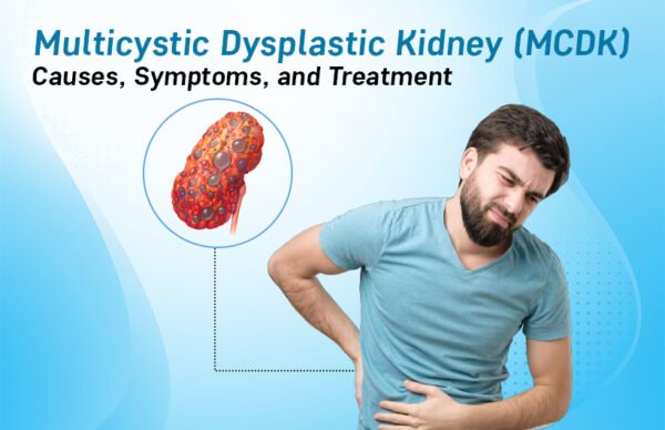 Multicystic Dysplastic Kidney (MCDK): Causes, Symptoms, Treatment ...