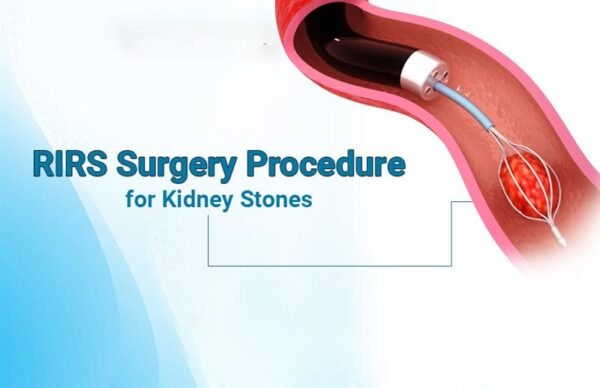 RIRS Surgery Procedure for Kidney Stones - Dr Ravi Bhadania